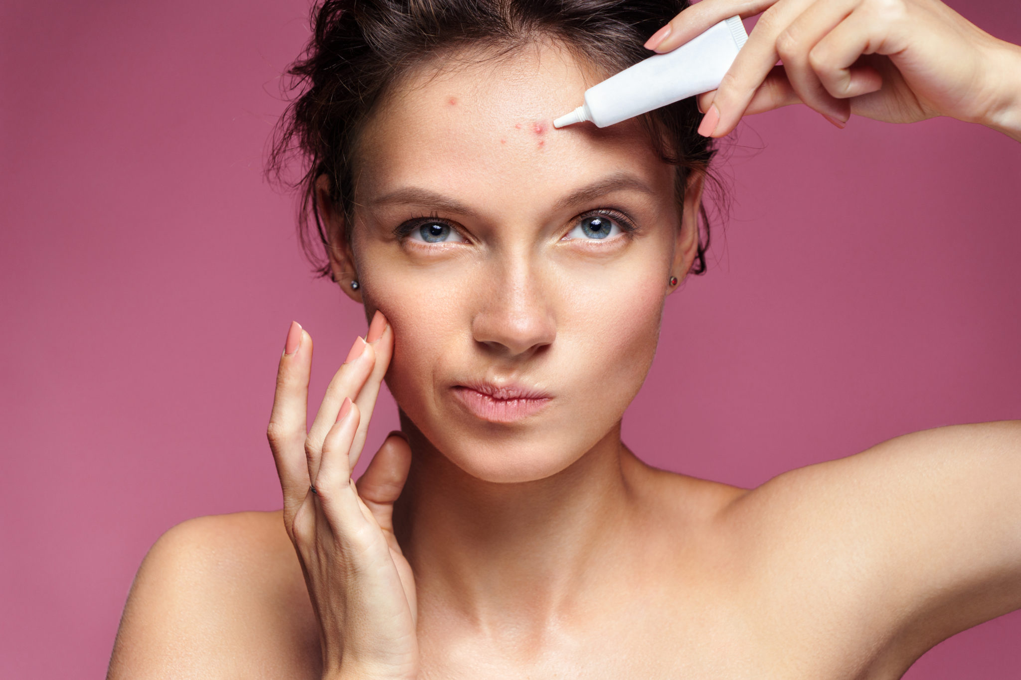 What Is Acne? Definition & Types | The Spa MD | MI