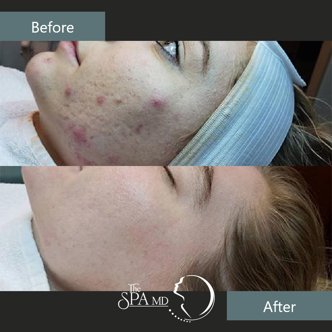 Before And After Gallery Of Face Treatments | The Spa MD