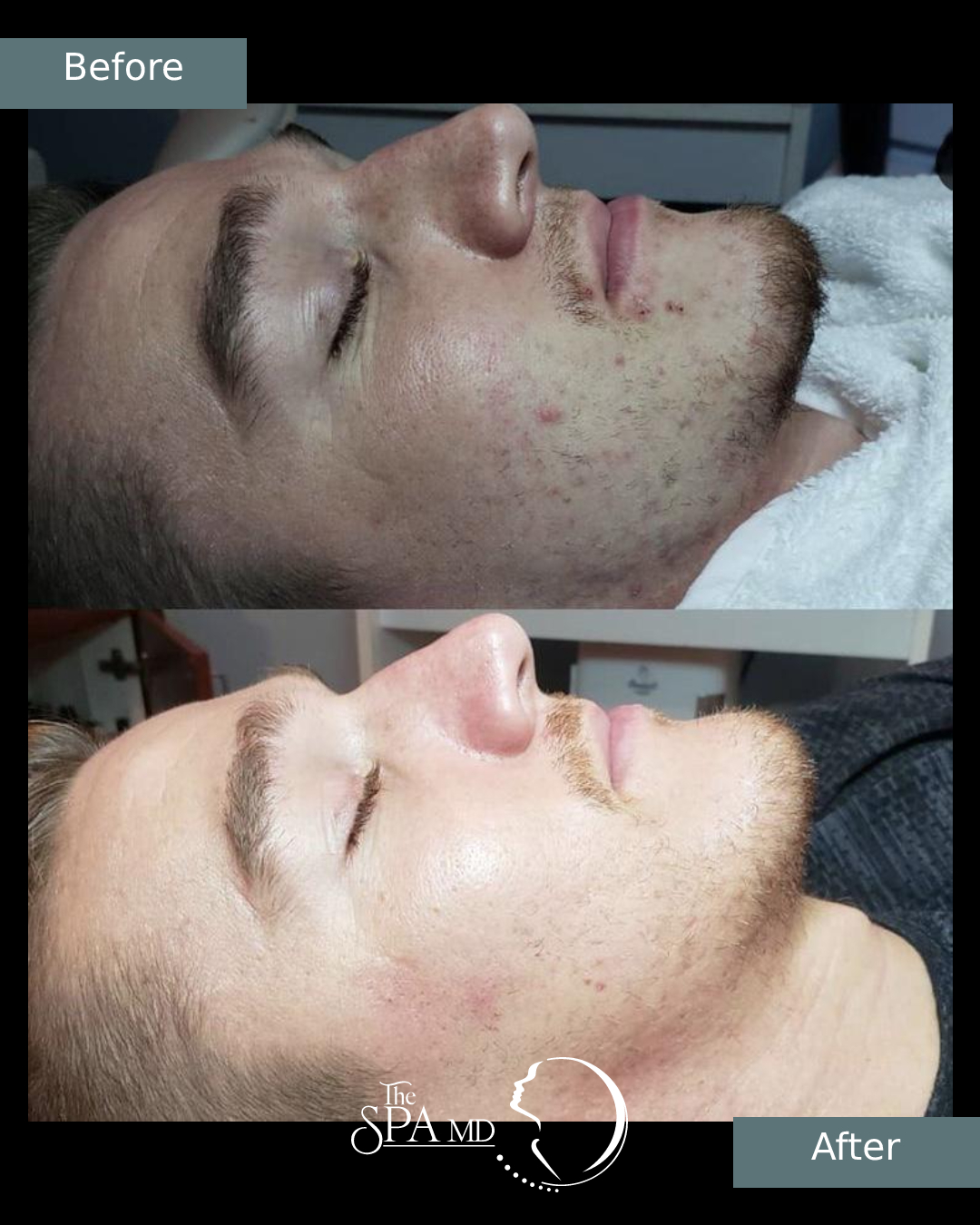 Before And After Gallery Of Face Treatments | The Spa MD