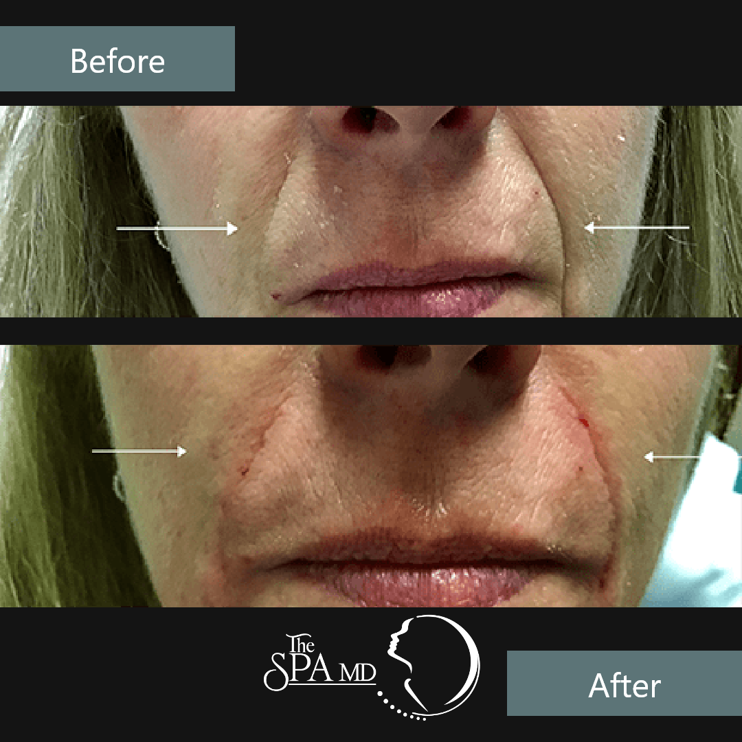 Before and After Gallery of Face Treatments | The Spa MD
