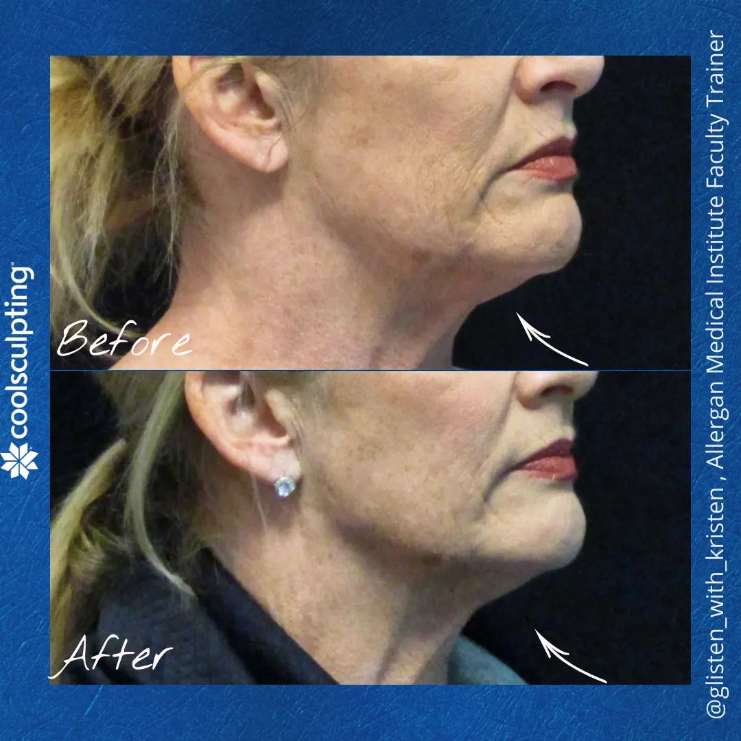 Before and After Gallery of Coolsculpting Treatments | The Spa MD